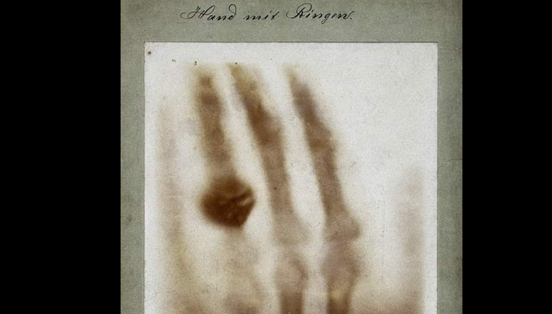 Foto e famshme: Unaza e martesës, imazhi i parë me Rrezet X - ObserverKult